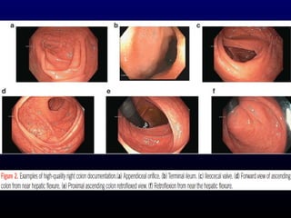 GIT Kurdistan Board GEH J Club CRC retroflexion. | PPT