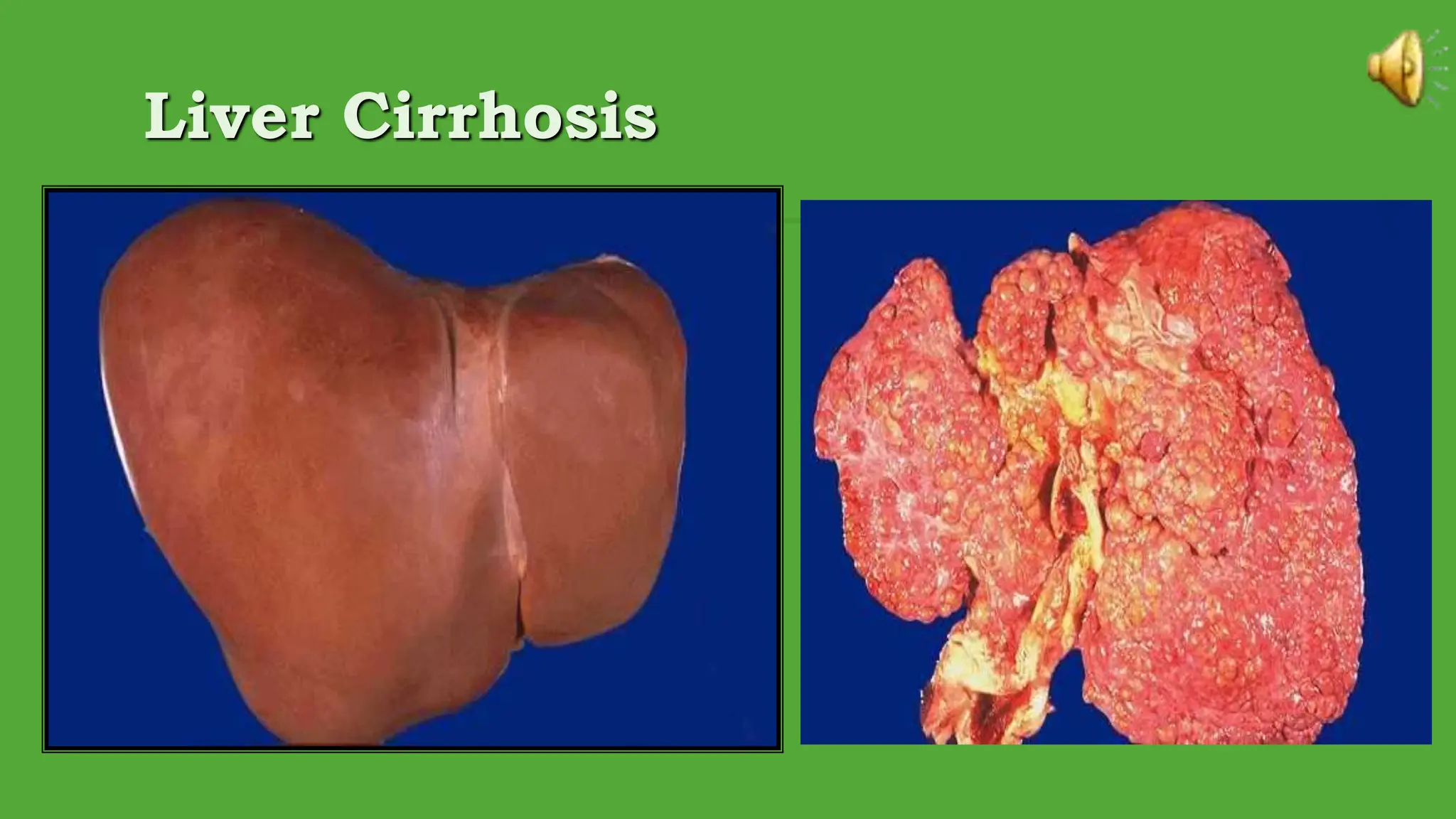 GIT LECTURE 9 liver cirhosis.pptx
