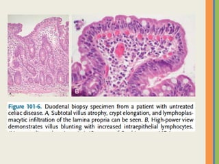 GIT malabsorption. | PPT