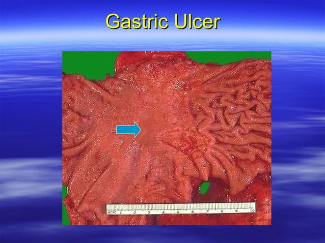 Pathophysiology of digestion. Violation of digestion in a stomach and ...