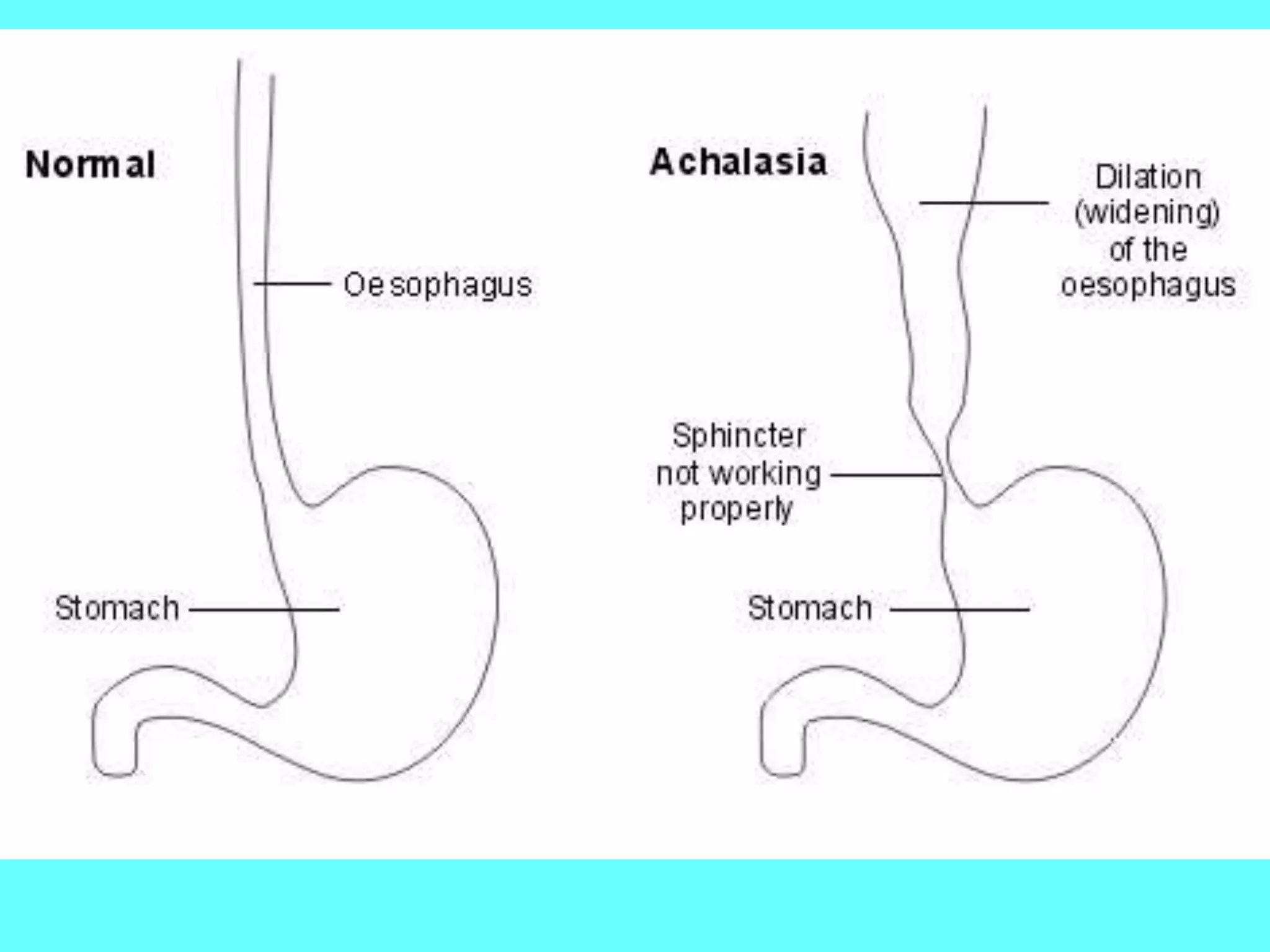 GIT (Dysphagia Syndrome) | PPT