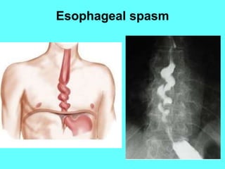 GIT (Dysphagia Syndrome) | PPTX