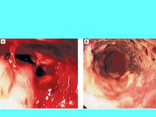 GIT (Dysphagia Syndrome) | PPTX