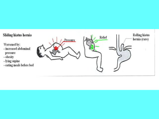 GIT (Dysphagia Syndrome) | PPTX