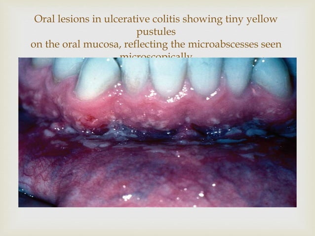 Git oral manifestation | PPT