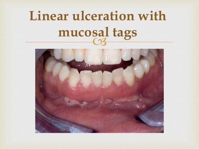 Git oral manifestation