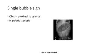 gastrointestinal tract radiology revison notes | PDF