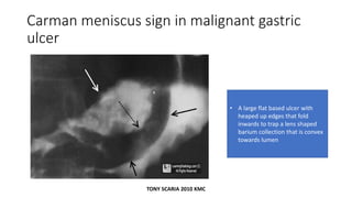 gastrointestinal tract radiology revison notes | PPT