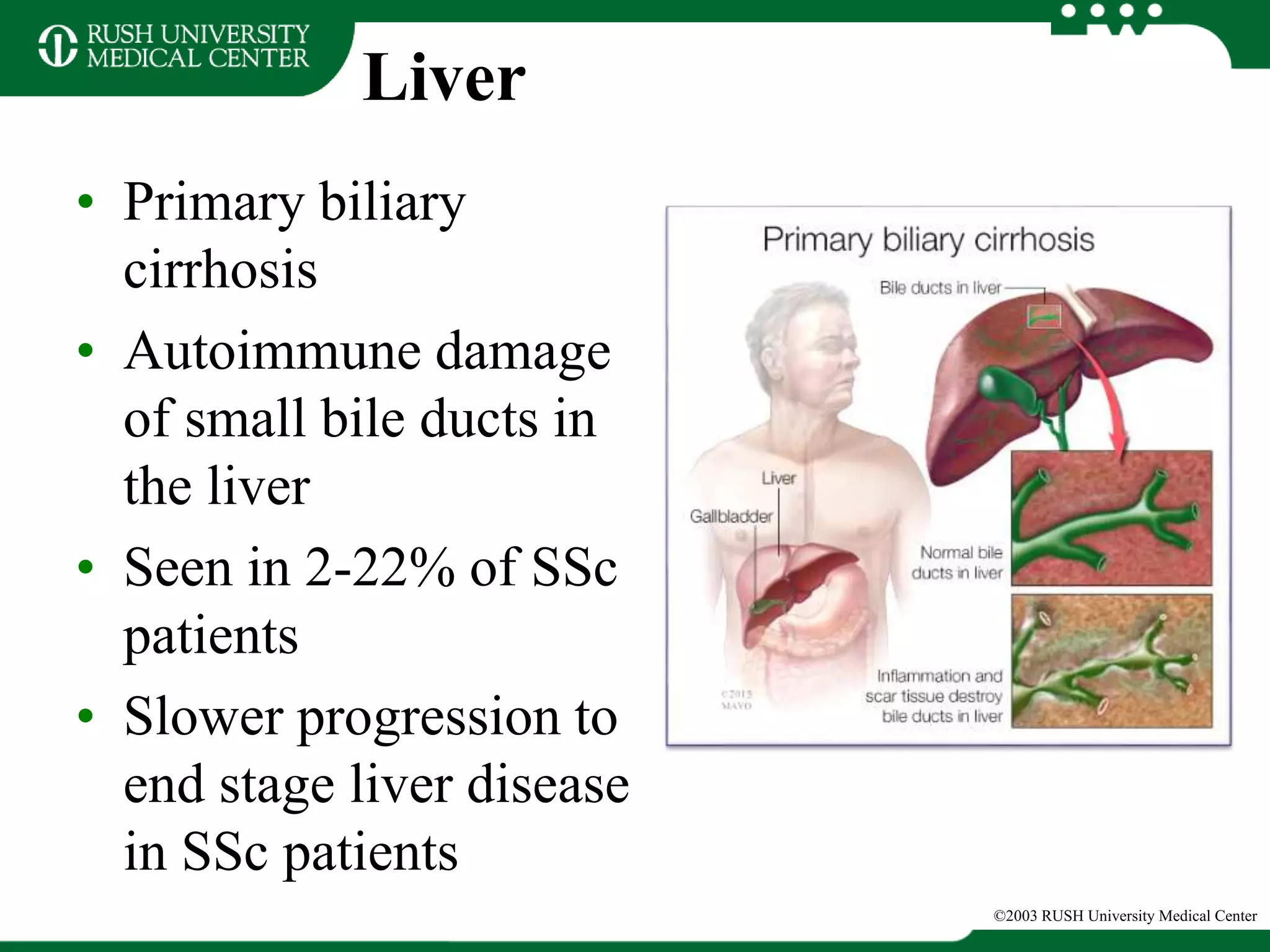 Scleroderma (Systemic Sclerosis) and the GI Tract | PPTX