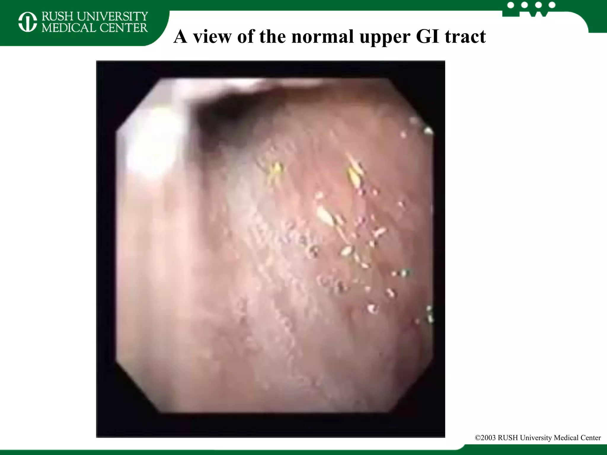 Scleroderma (Systemic Sclerosis) and the GI Tract | PPTX