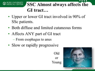 Scleroderma (Systemic Sclerosis) and the GI Tract | PPTX