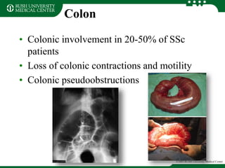 Scleroderma (Systemic Sclerosis) and the GI Tract | PPT