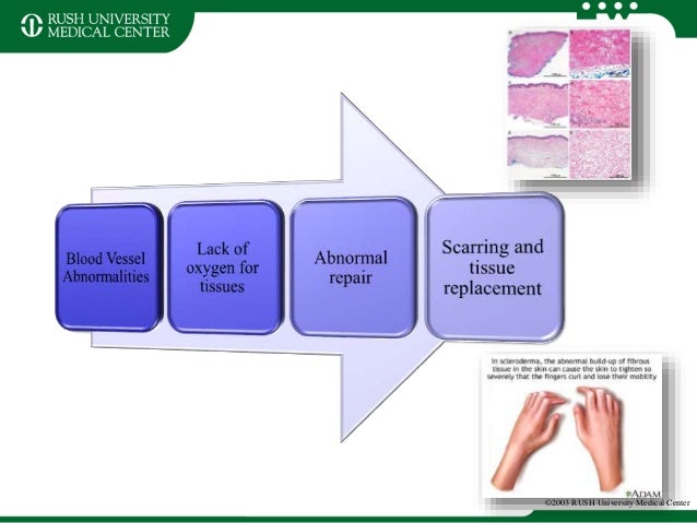 Scleroderma (Systemic Sclerosis) and the GI Tract