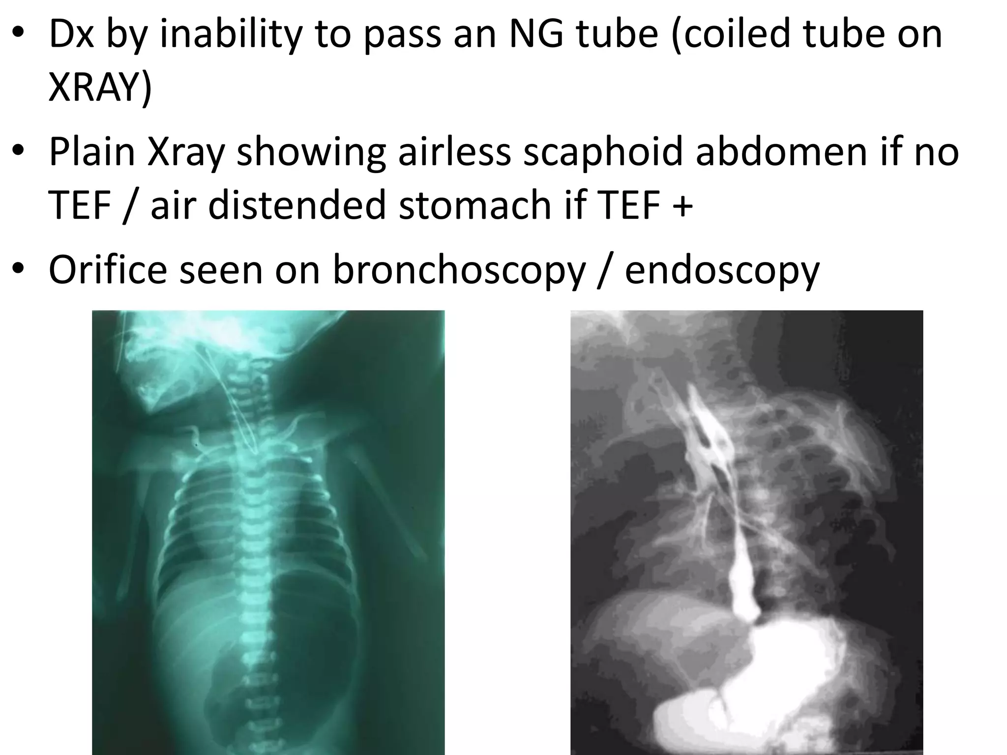 DEVELOPMENT OF GIT AND CONGENITAL ANOMALIES OF GIT | PPTX