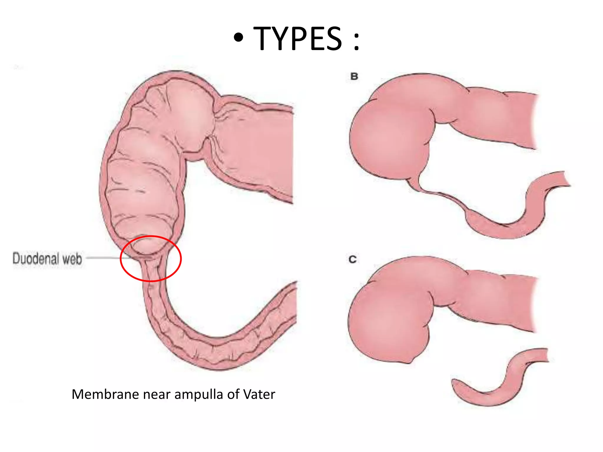 DEVELOPMENT OF GIT AND CONGENITAL ANOMALIES OF GIT | PPTX