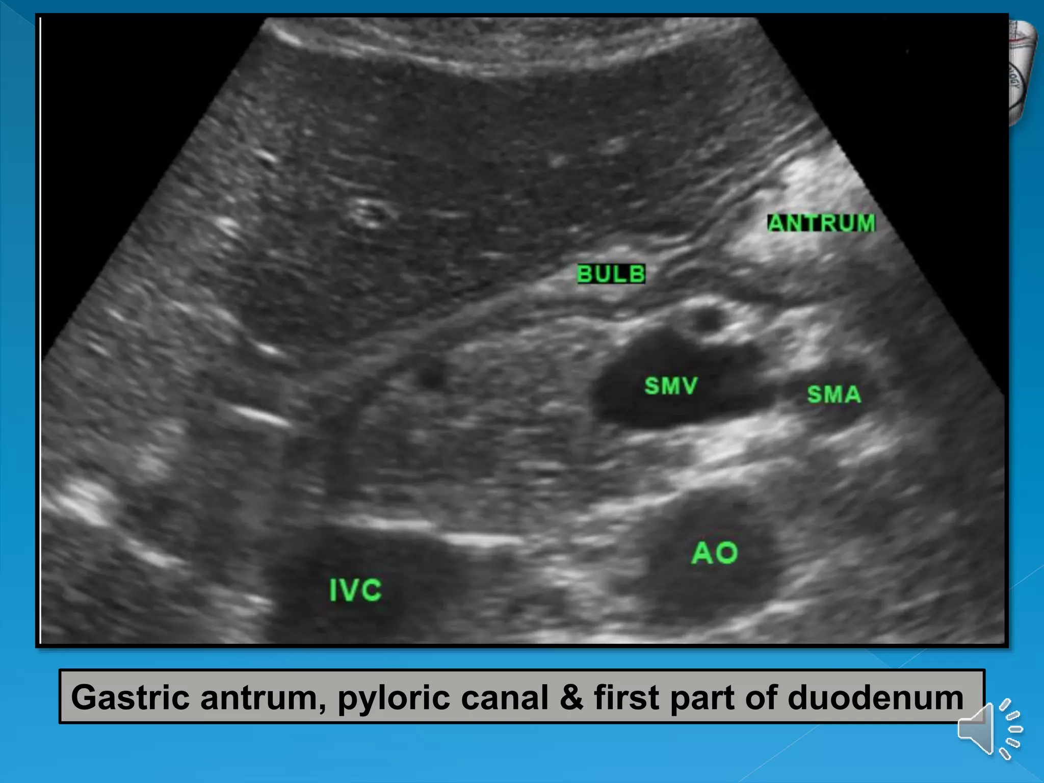 Git ultrasound part I technique & normal appearance | PPT