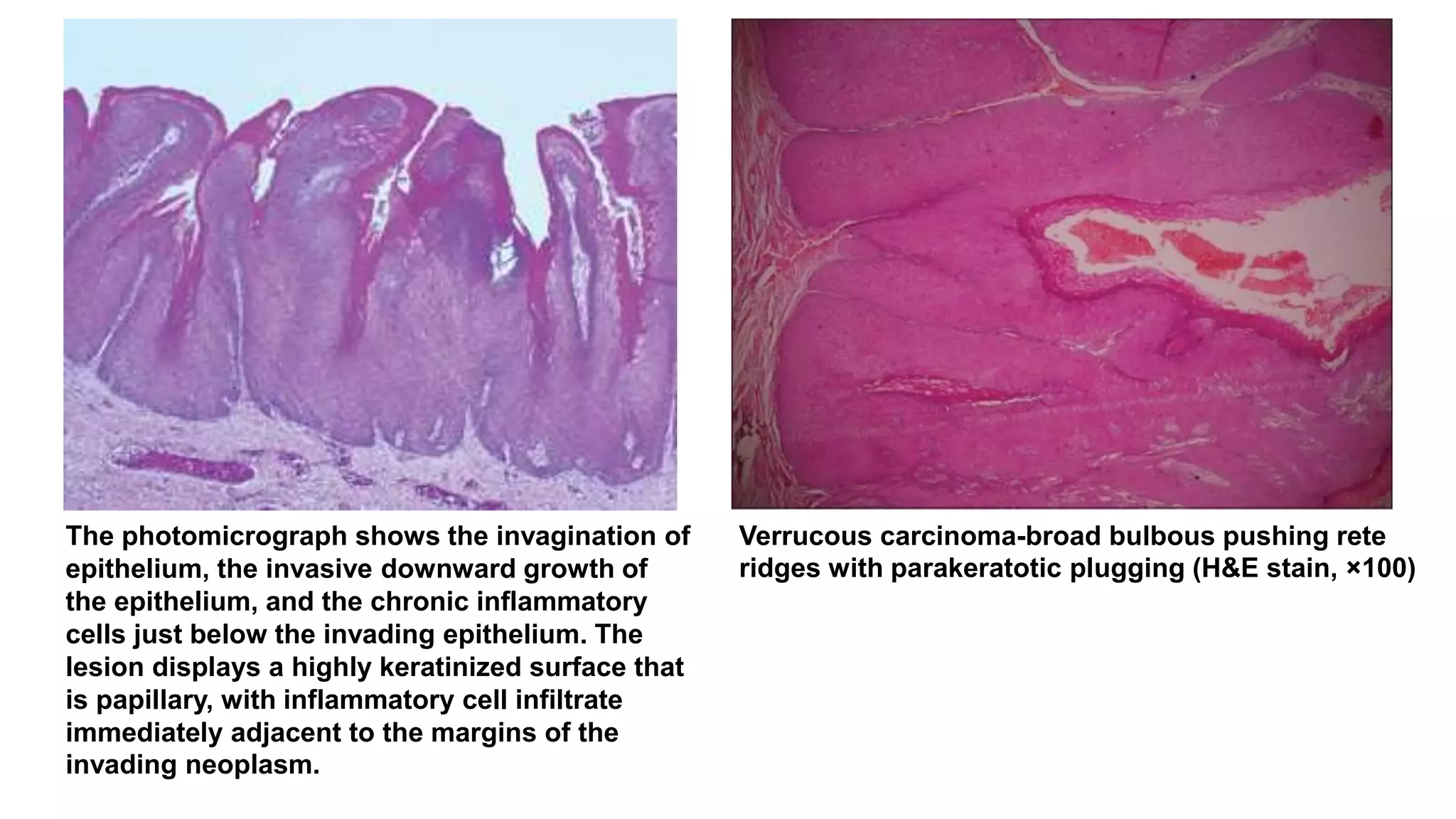 Histopathological variants of squamous cell carcinoma (Doctor Faris ...