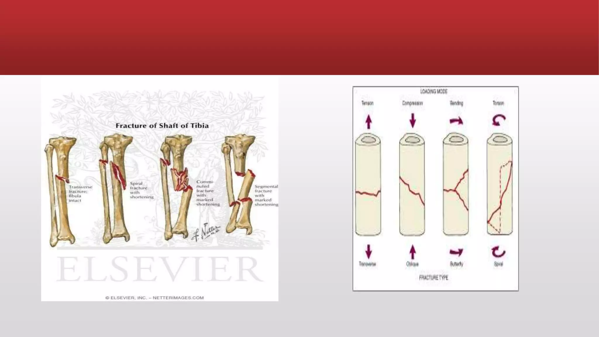 Lower limb fractures-Orthopedics | PPTX