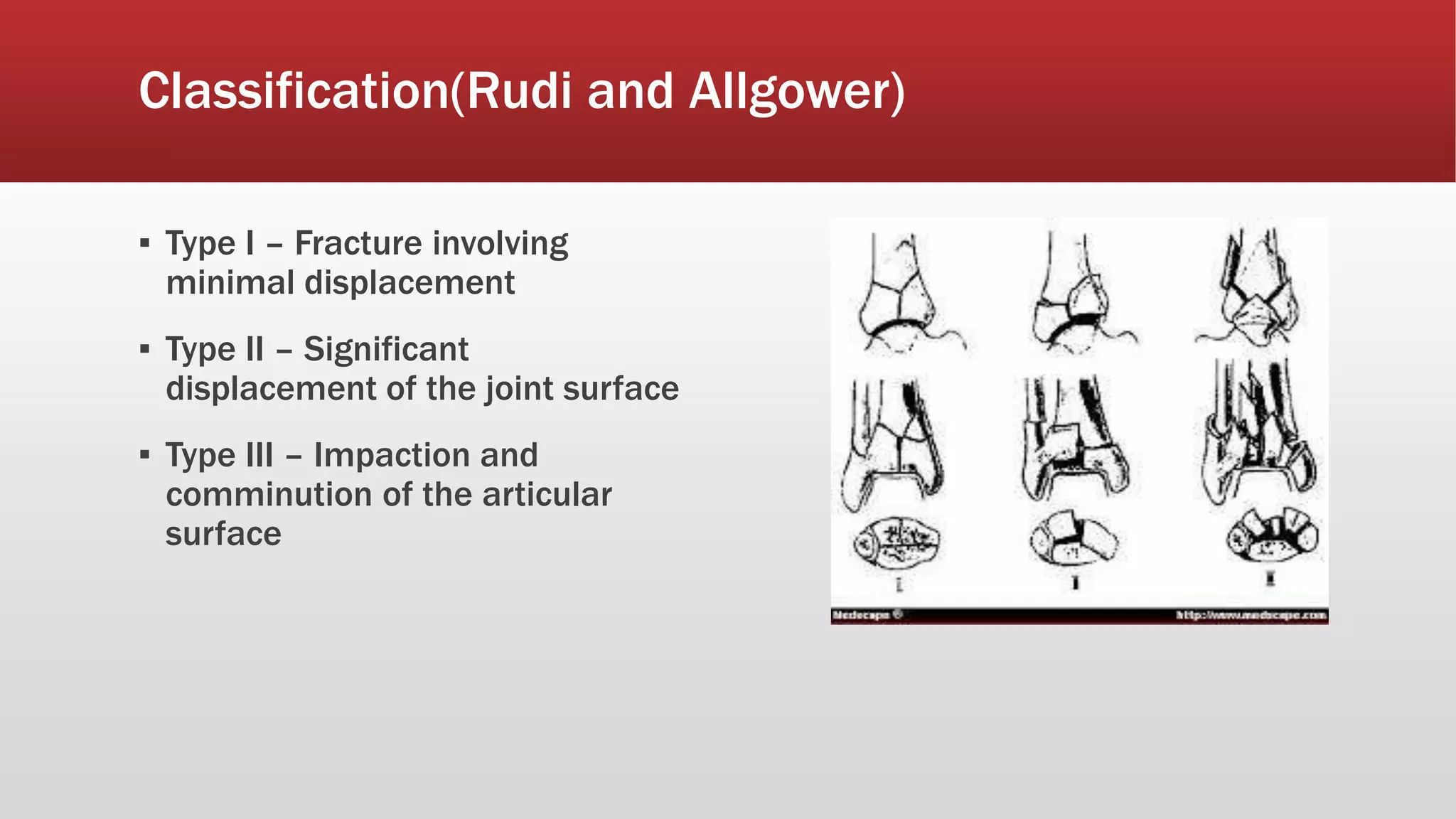 Lower limb fractures-Orthopedics | PPTX