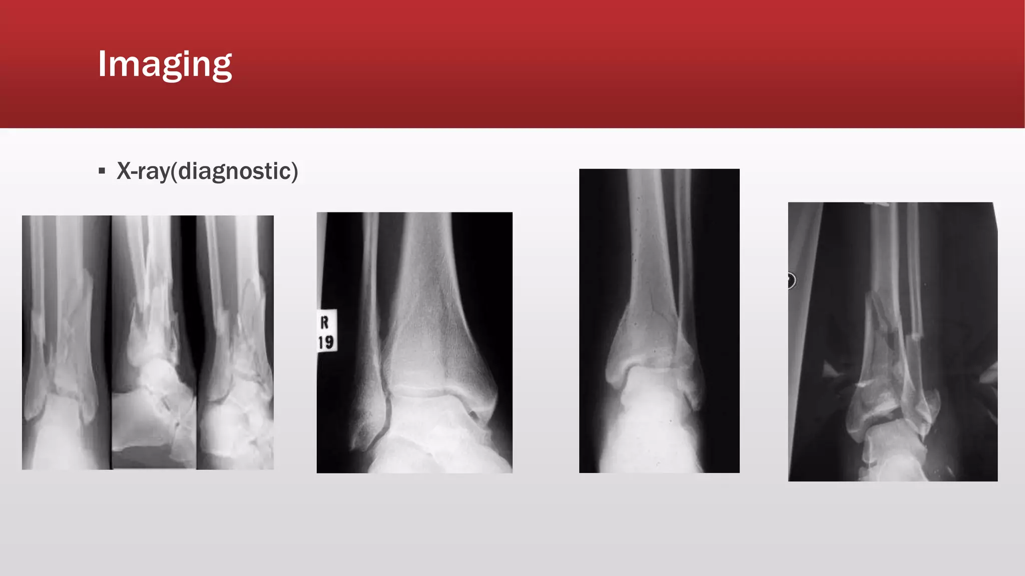 Lower limb fractures-Orthopedics | PPTX