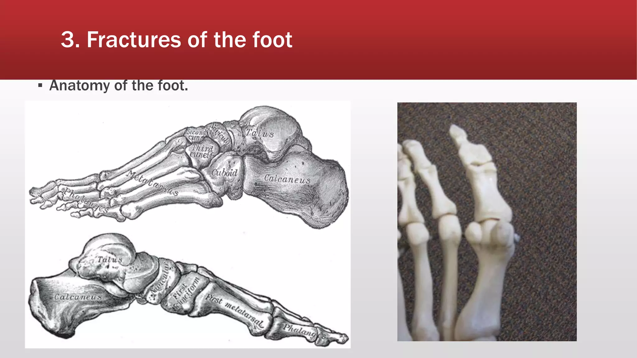 Lower limb fractures-Orthopedics | PPTX