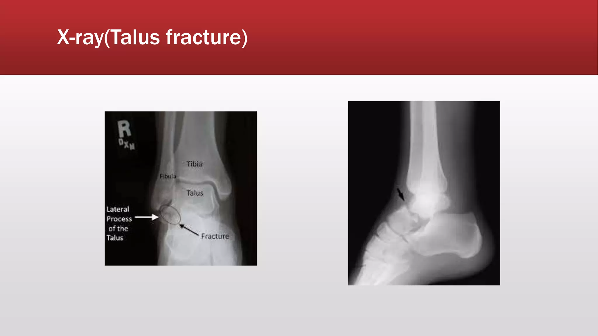 Lower limb fractures-Orthopedics | PPTX