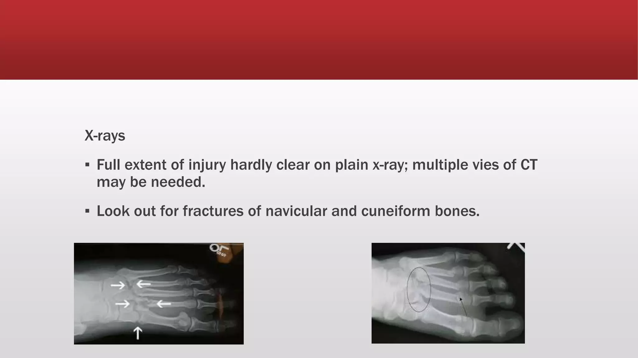Lower limb fractures-Orthopedics | PPTX