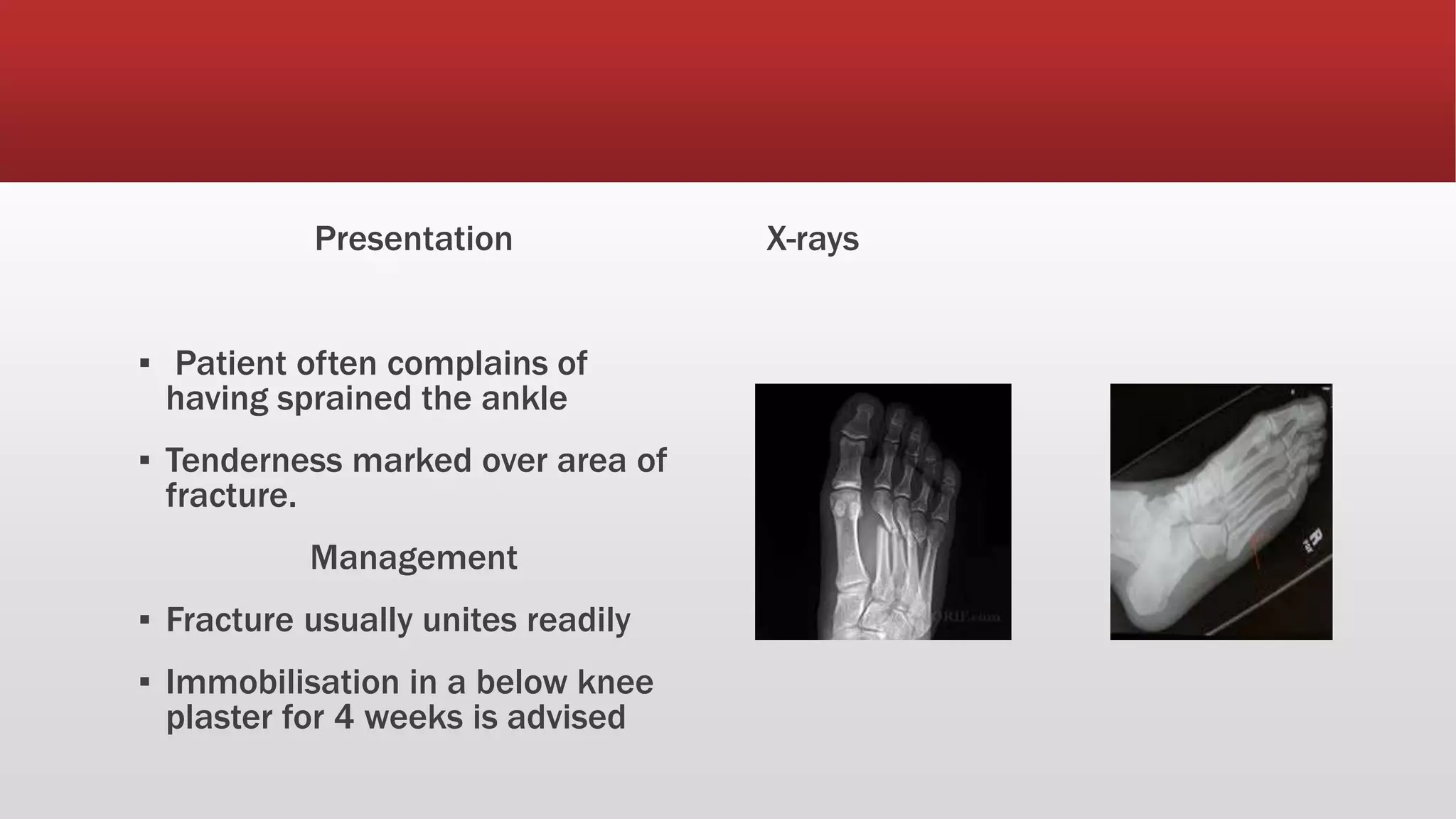 Lower limb fractures-Orthopedics | PPTX