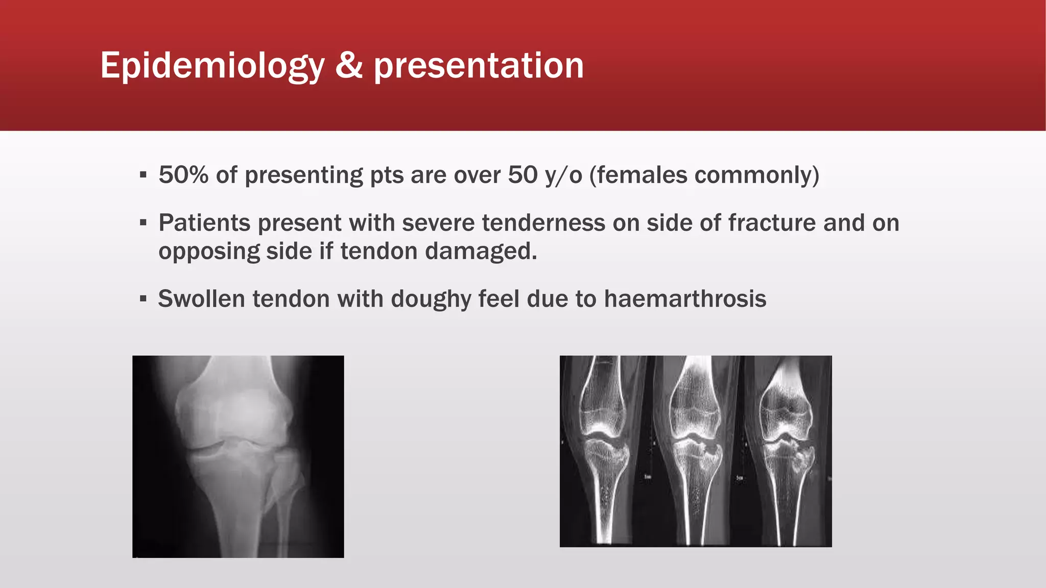 Lower limb fractures-Orthopedics | PPTX