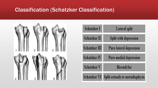 Lower limb fractures-Orthopedics | PPTX