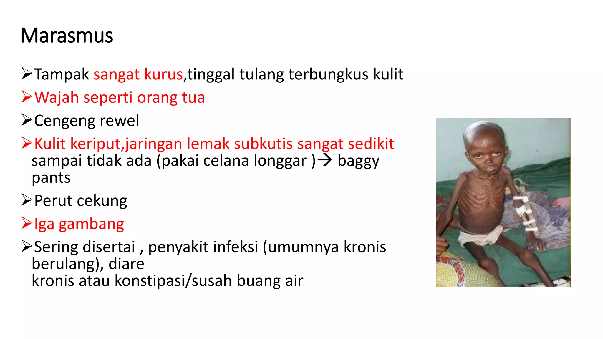 Gizi Buruk Pada Anak.pptx