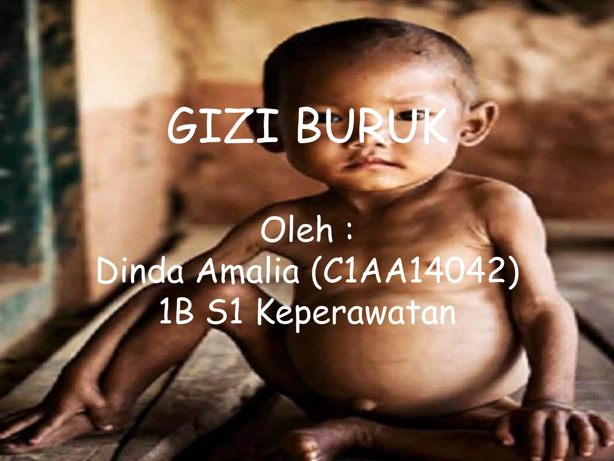 Gizi buruk balita di jawa barat | PPT