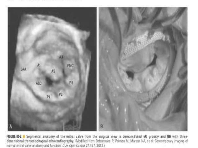 Mitral valve anatomy | PPTX | Heart and Cardiovascular Diseases ...