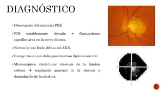 Glaucoma pseudoexfoliativo | PPTX