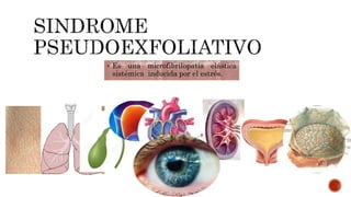 Glaucoma pseudoexfoliativo | PPTX