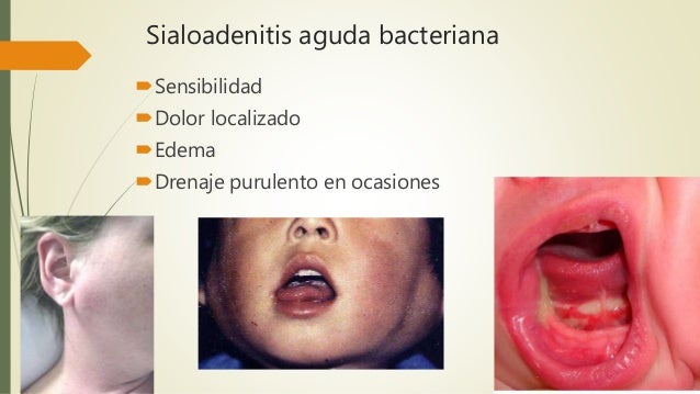 Enf. de glandulas salivales en pediatria