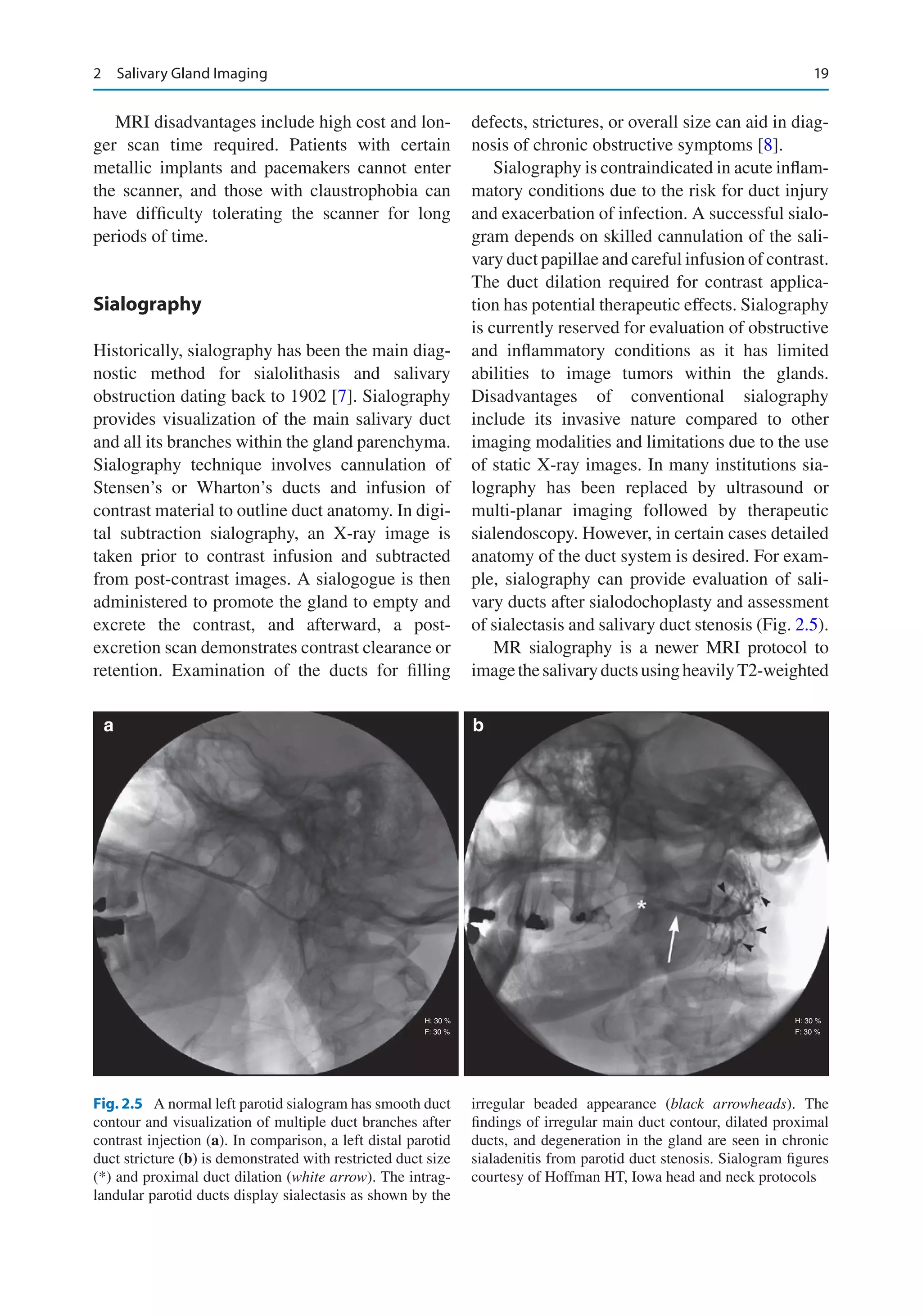 Gland preserving salivary surgery | PDF