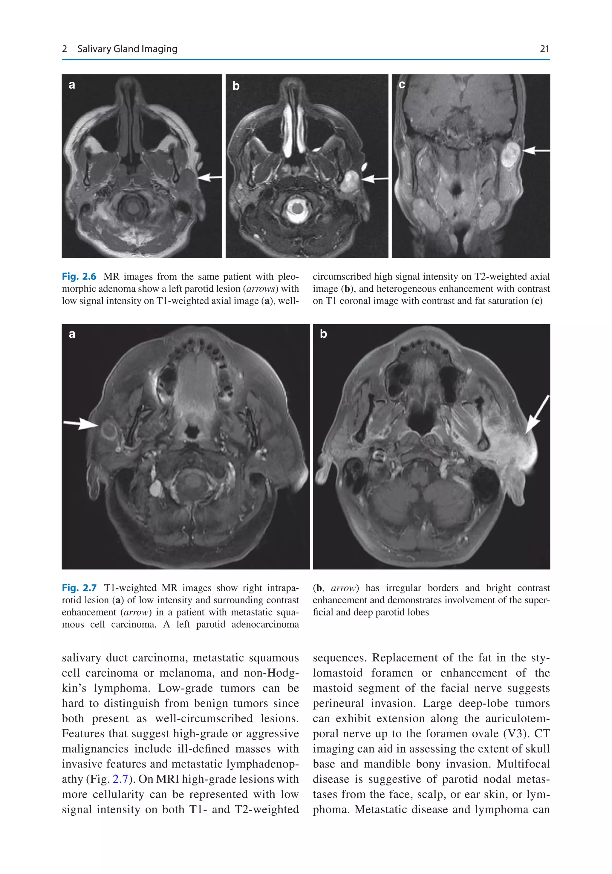Gland preserving salivary surgery | PDF