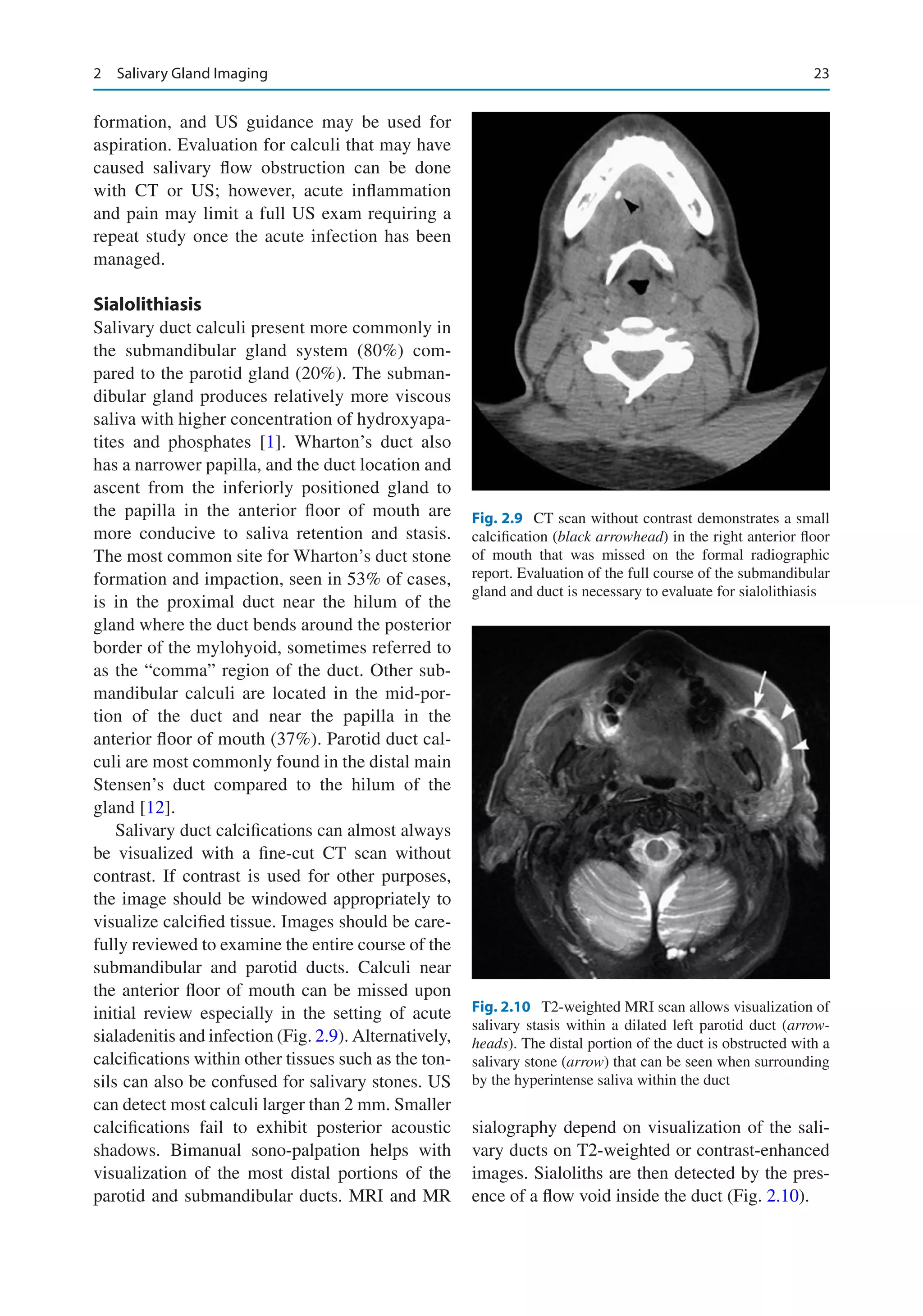 Gland preserving salivary surgery | PDF