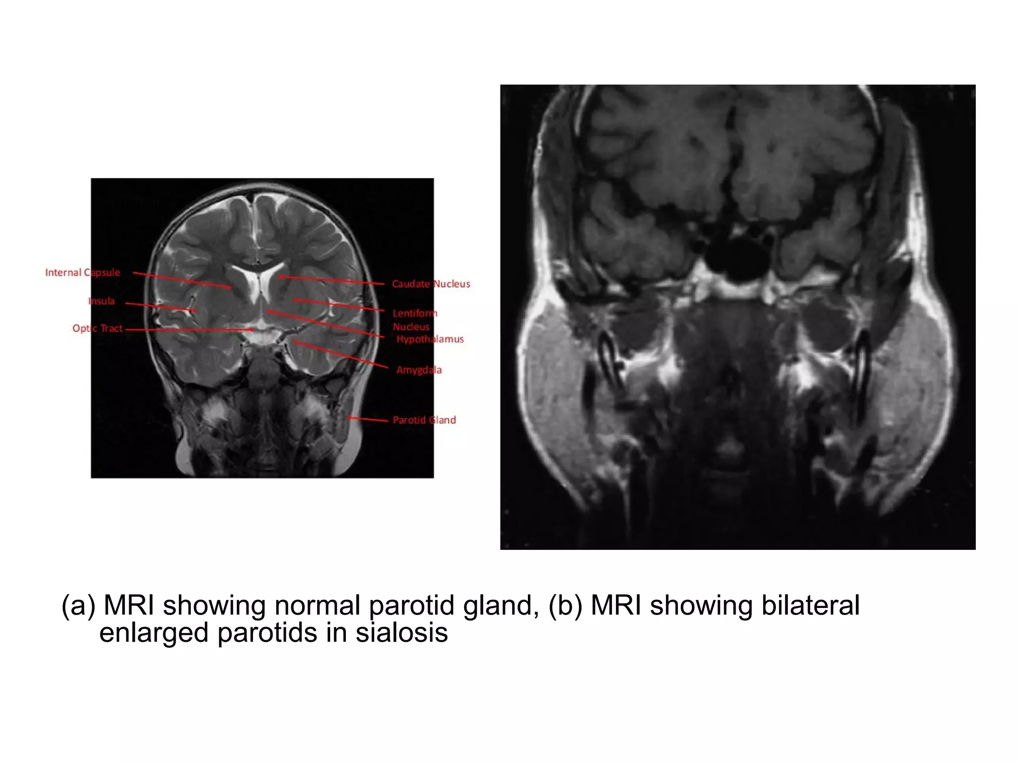 Diagnostic Imaging of Salivary, Parathyroid and Thyroid Glands | PPT