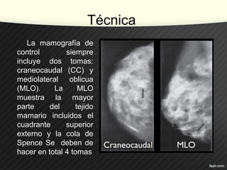Glandula mamaria Radiología | PPT