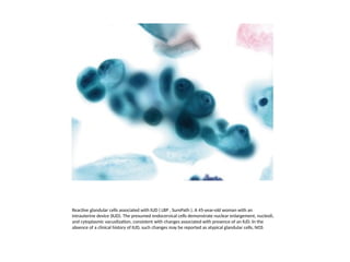 Glandular lesion of cervix in pap smear. | PPTX