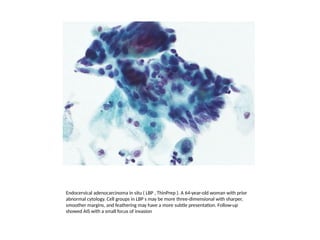 Glandular lesion of cervix in pap smear. | PPTX