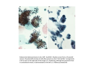 Glandular lesion of cervix in pap smear. | PPTX