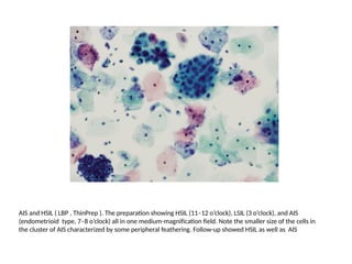 Glandular lesion of cervix in pap smear. | PPTX