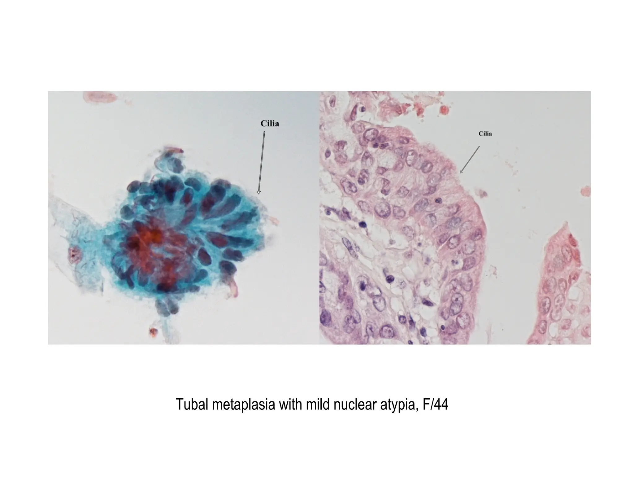 GLANDULAR LESIONS CYTOLOGY IN CERVICAL CYTOLOGY.pdf