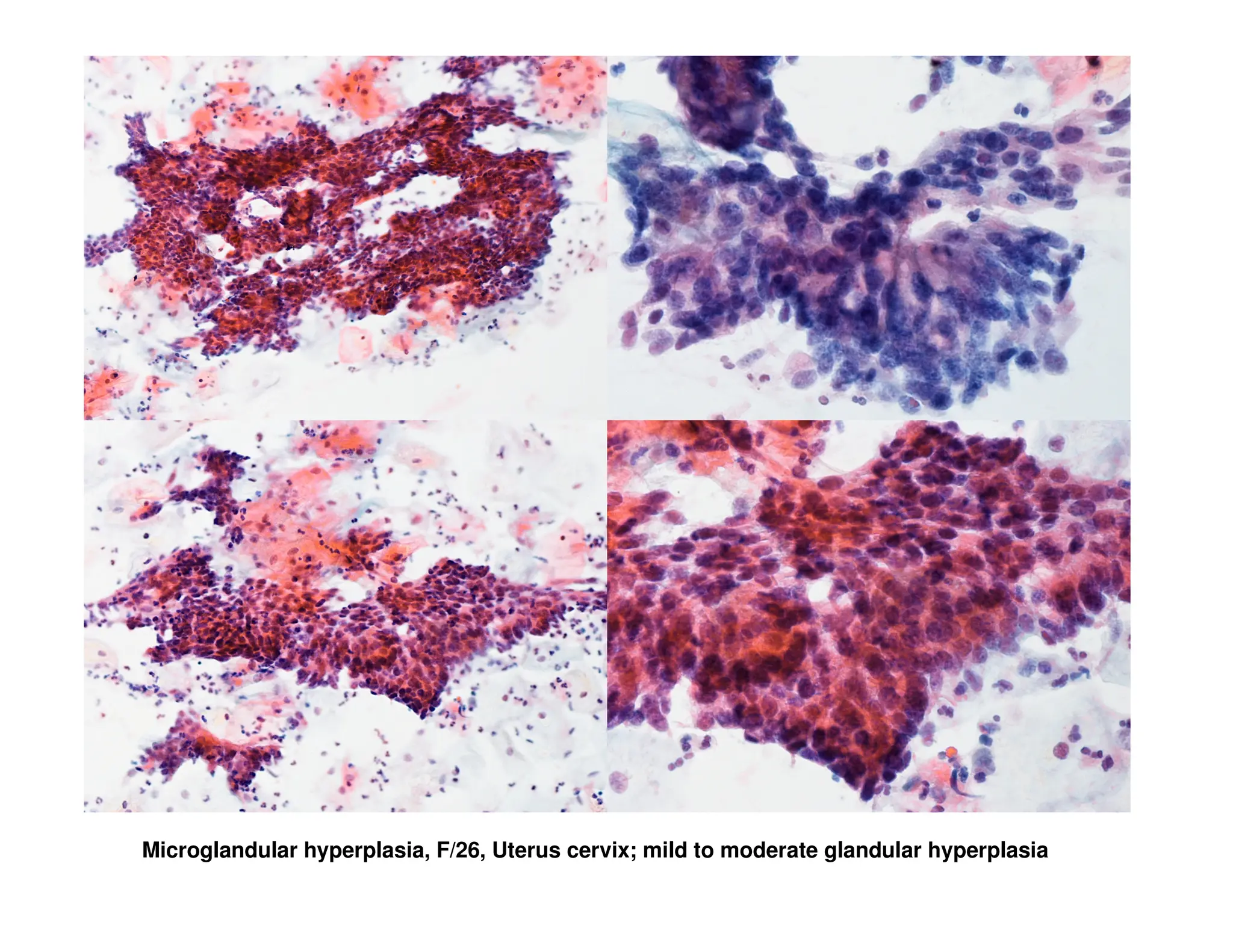 GLANDULAR LESIONS CYTOLOGY IN CERVICAL CYTOLOGY.pdf