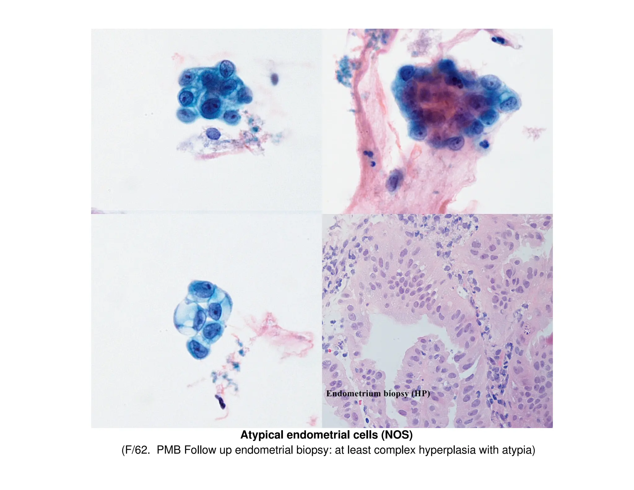 GLANDULAR LESIONS CYTOLOGY IN CERVICAL CYTOLOGY.pdf