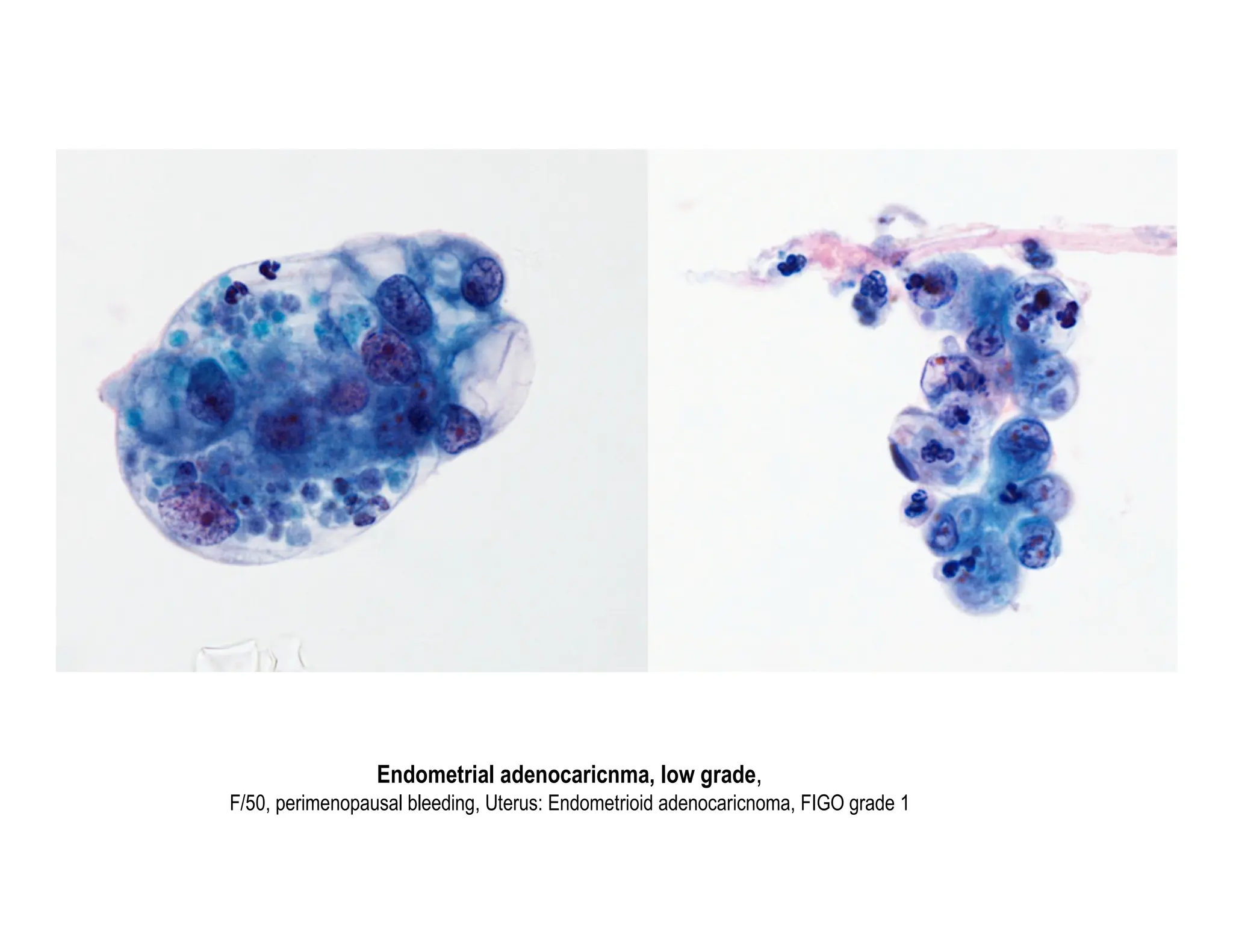GLANDULAR LESIONS CYTOLOGY IN CERVICAL CYTOLOGY.pdf