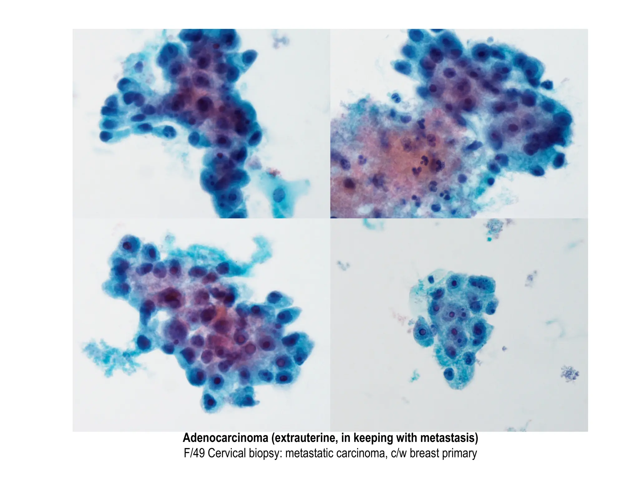 GLANDULAR LESIONS CYTOLOGY IN CERVICAL CYTOLOGY.pdf